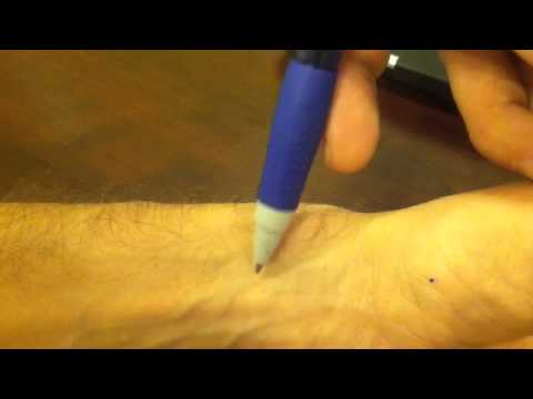 Acupuncture Pulse Diagnosis