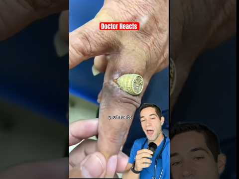 This ring fused with his skin?!