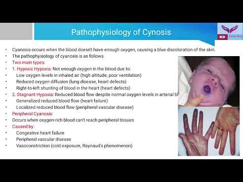 General Examination| Cyanosis - Recognizing the Blue Tint - A Guide to Clinical Examination |