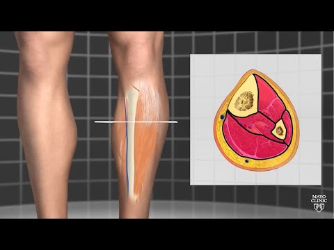 Mayo Clinic Orthopedics and Sports Medicine: Chronic Exertional Compartment Syndrome