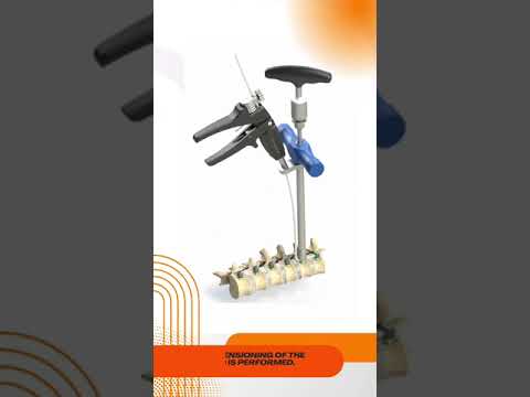 Tria Spine Medical: KYRA®️ Correction Cord System