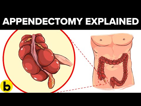 9 Things You Should Know About An Appendectomy