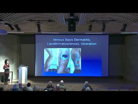 BCH Lecture: Say Goodbye to Varicose Veins