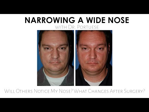 Will people notice I got a nose job?