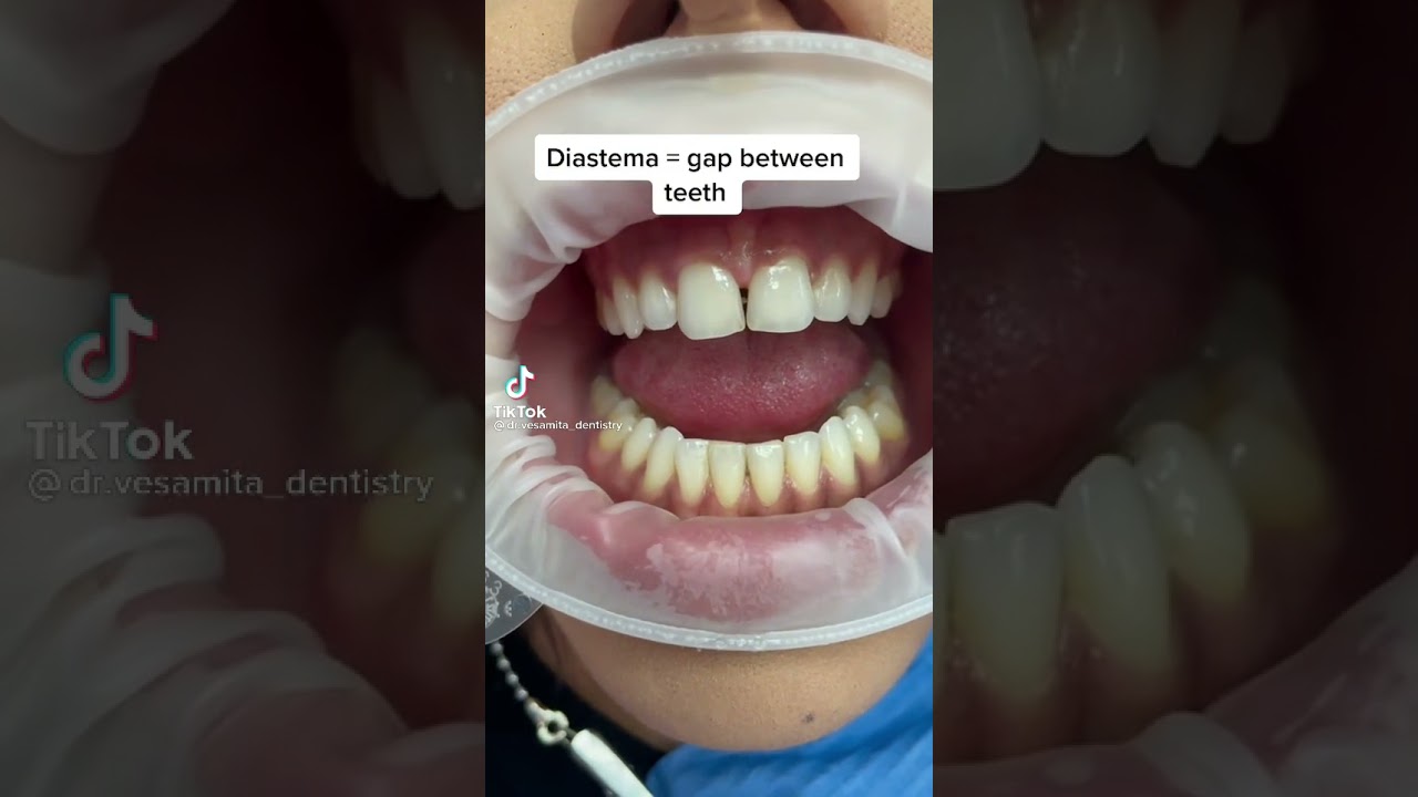 Best way to fix a Diastema - Gap Between Teeth
