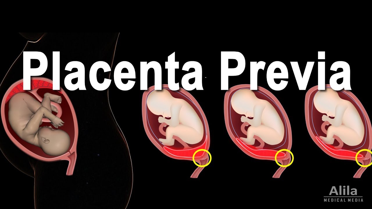 Low Lying Placenta - Placenta Previa, Animation