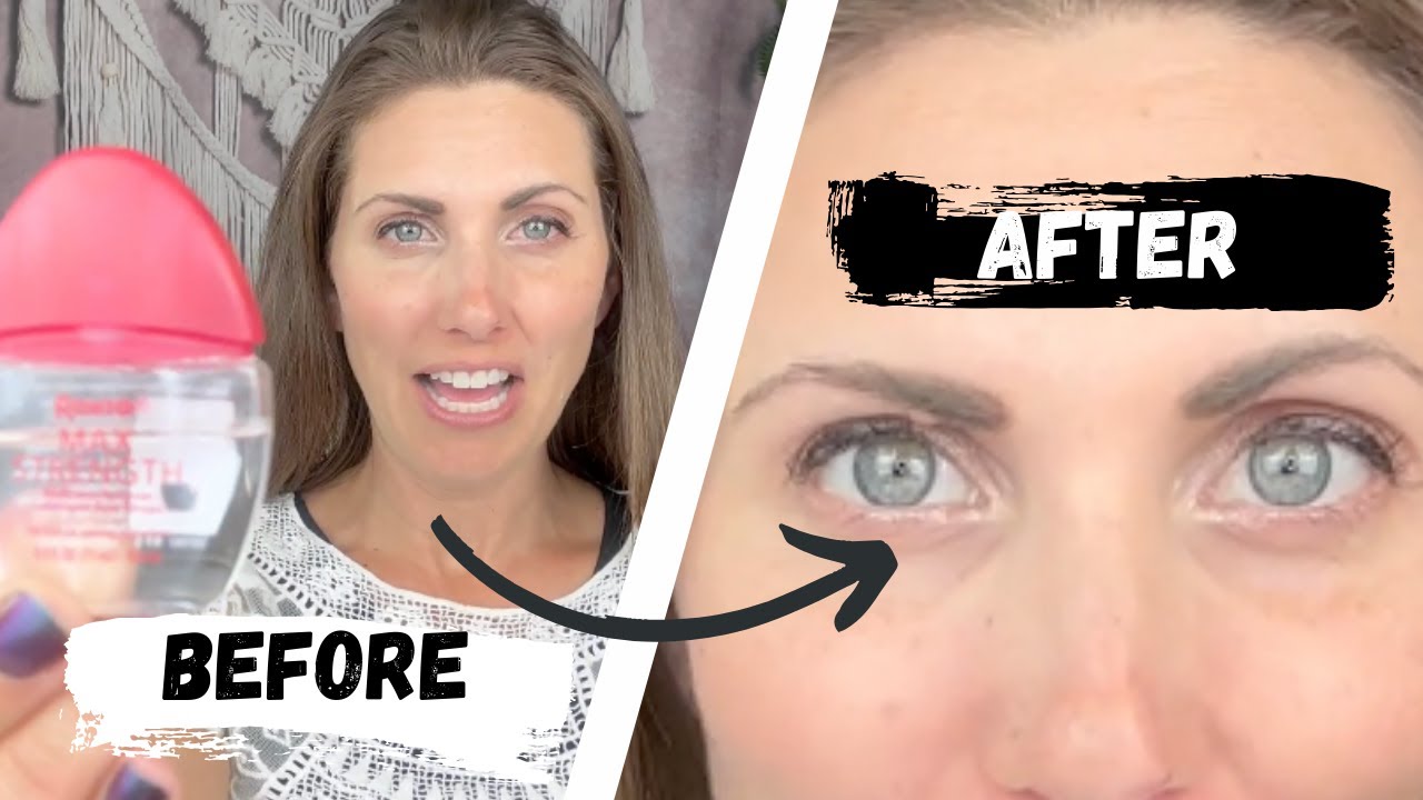 Whiter Eyes with Rohto Red Eye Drops - Witness the Difference!