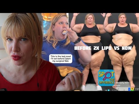 BodyBuilder Reacts To Glitter&Lazers INSPIRING Bad Surgery To Viewers + Spot The Difference Pre Lipo