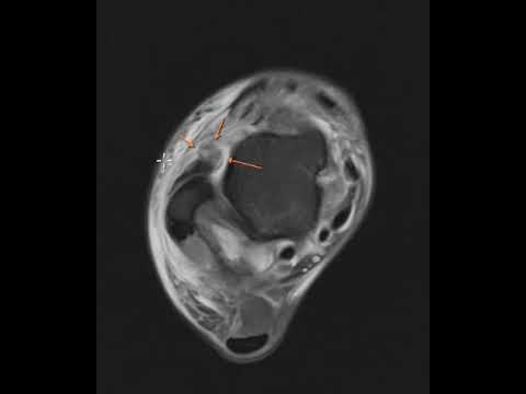 Anterior talofibular ligament tear and posterior tibial tendon tear