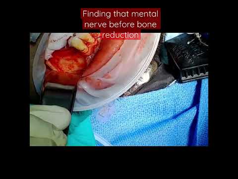 Escubidubidu Finding that Mental Nerve and Marking it