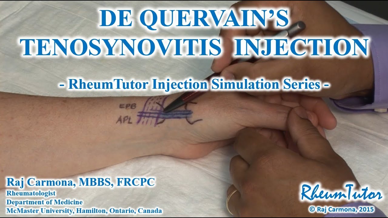 DE QUERVAIN'S TENOSYNOVITIS INJECTION: Step-By-Step Instructions