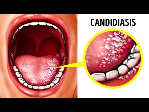 My Tongue Turned White, It Turns Out I've a Fungal Infection