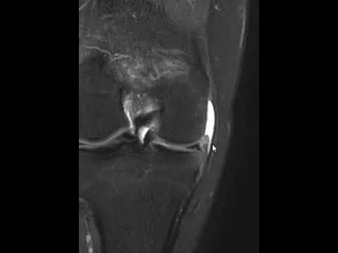 Knee MRI scan - Medial Collateral Ligament Anatomy (MCL and medial meniscus tear)