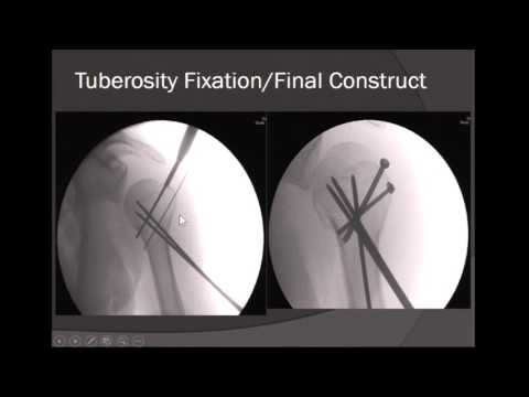 Proximal humerus fractures: practical tips and techniques for optimal management