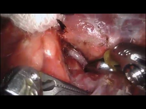 Lobectomy on the Da Vinci Xi | Dr. Daniel Fortes