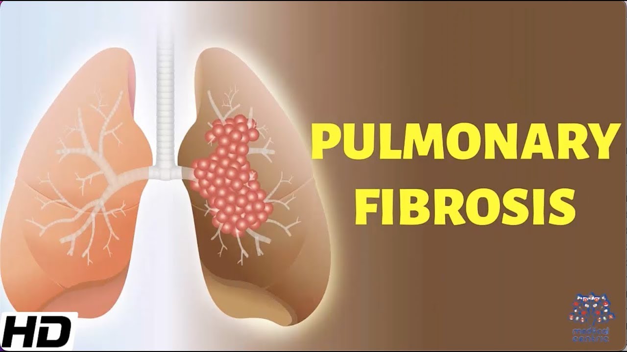 Pulmonary Fibrosis