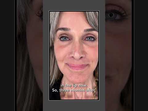 A Dog Attack & A Dozen Doctors Later - Upper Lip Reconstruction
