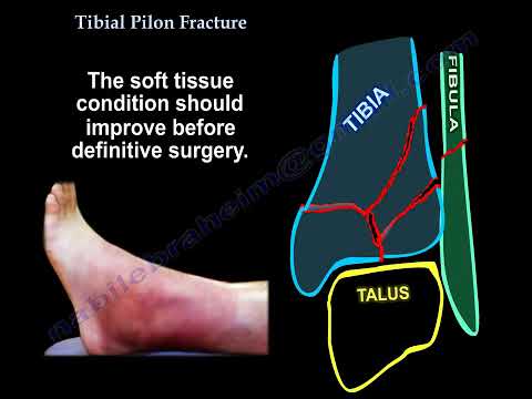 Tibial Pilon Fracture