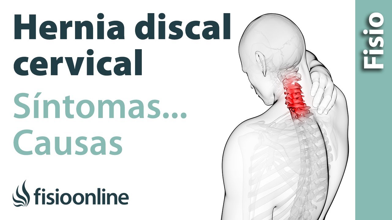¿Qué es la hernia discal cervical y cuáles son sus causas y síntomas?