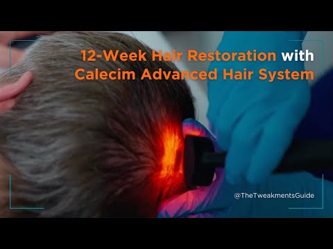 12-Week Hair Restoration with Calecim Advanced Hair System
