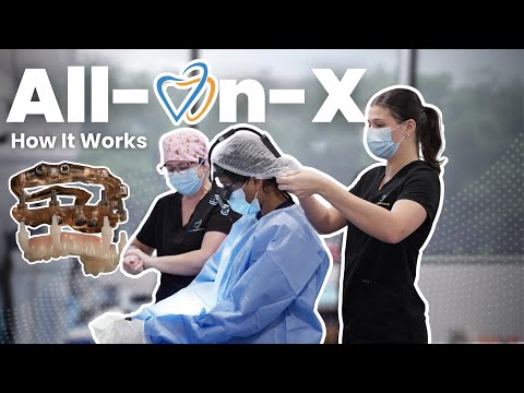 All-On-X Implants Explained: Cost, Procedure & Recovery