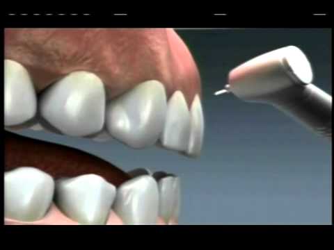 Enhancing Dental Treatment with Laser Dentistry