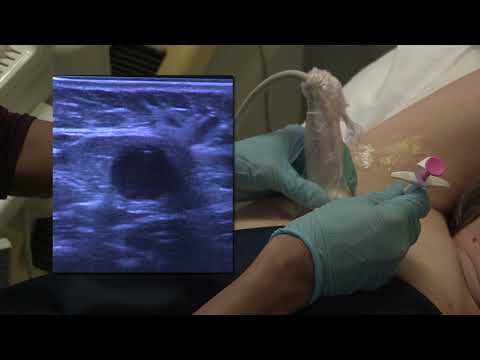 Marking the Axillary Node using a clip