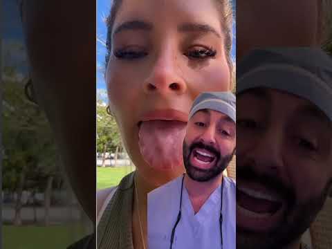Macroglossia, scalloped and geographic tongue…not tongue cancer! Also check for sleep apnea!