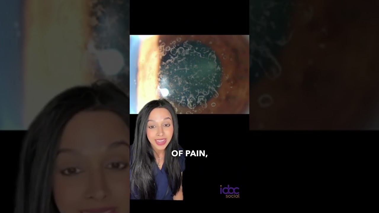 Granular Corneal Dystrophy - Dr. Aparna Shah
