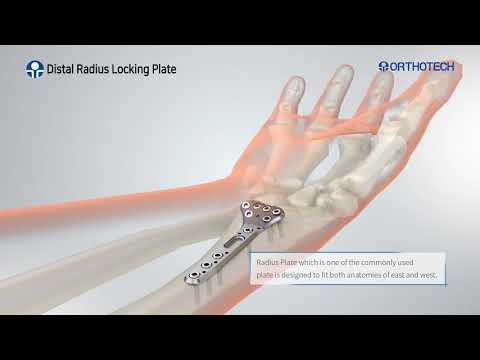 ORTHO TECH (Multi-Fix) Anatomical Locking Plate