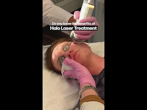 Discover the magic of Halo Laser Treatment, the ultimate skin rejuvenation solution! 🙌