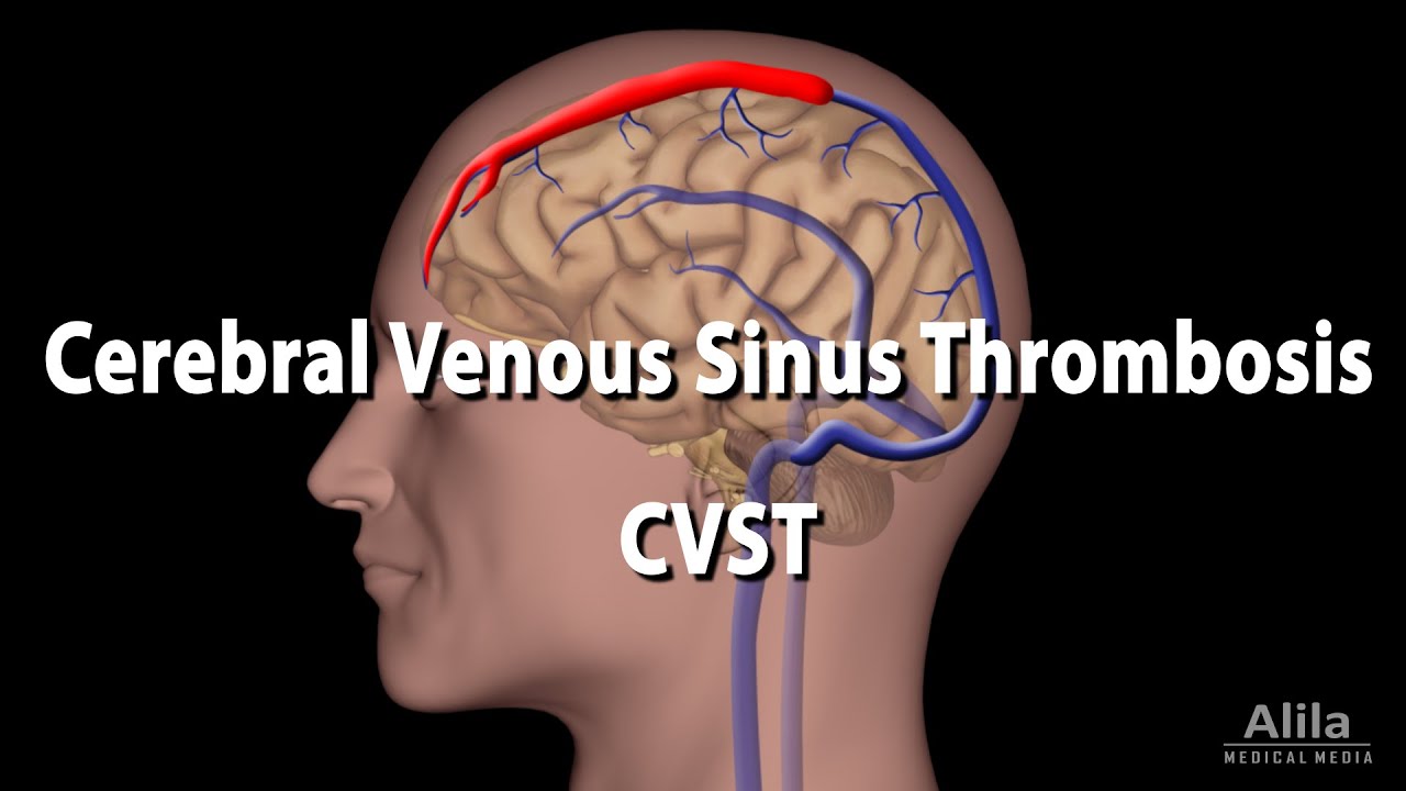 Cerebral Venous Sinus Thrombosis, CVST, Animation