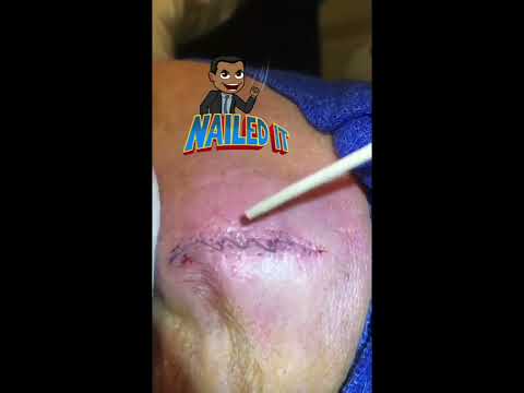 "Running W-plasty" Scar Revision - Snapchat Story