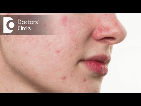 Are any topical creams continued with Lasers for treating Acne scars? - Dr. K Prem Anand