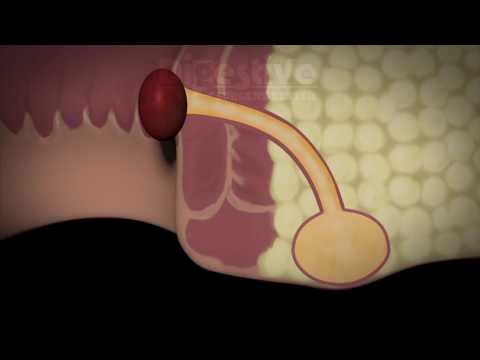 ANAL FISTULA TREATMENT - 3D ANIMATION