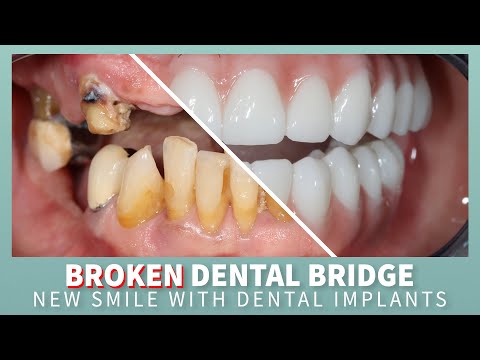 Broken Bridge: Smile Restored with a new smile on Innovative Dental Implants