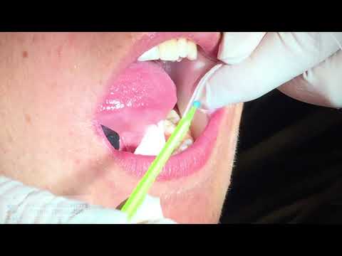 Superfloss Technique Tutorial using Silver Diamine Fluoride SDF by Dr. Jeanette MacLean,DDS