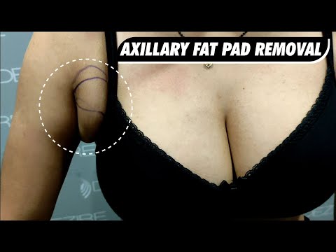 One sided Axillary breast tissue removal @dezireclinic