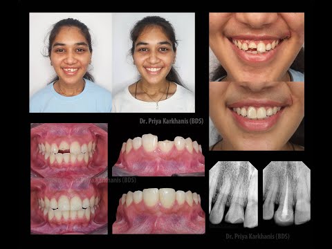 Management of Fractured Maxillary Central Incisors with Enododontic Treatment & Emax Crown