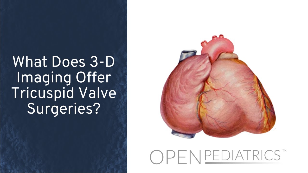 What Does 3-D Imaging Offer Tricuspid Valve Surgeries? by G. Marx | OPENPediatrics