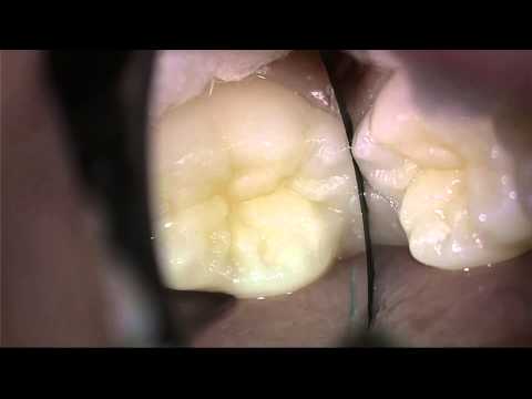 Super Sealants