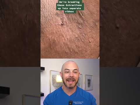 Derm reacts to armpit cyst removal! #dermreacts #doctorreacts #HS #cyst