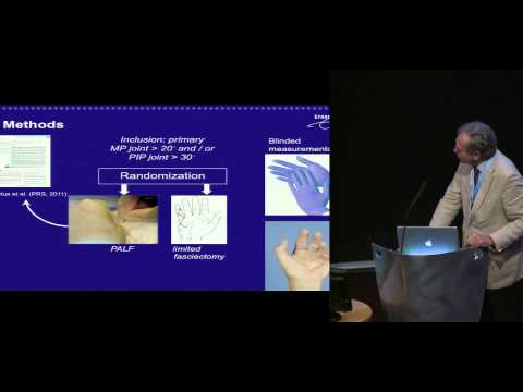 Dr. Steven Hovius: Percutaneous Aponeurotomy and Lipofilling" 2015 Dupuytren Symposium