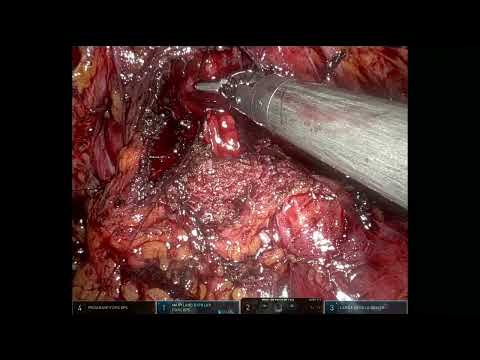 Robotic assisted radical prostatectomy: Bilateral hood sparing "Anterior Retzius" sparing RARP