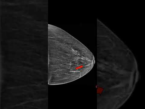 3.Ductal Ectasia of Breast Mammography@#@Breast cancer@#@abnormal Breast@#@#Awerenes of All@#short@