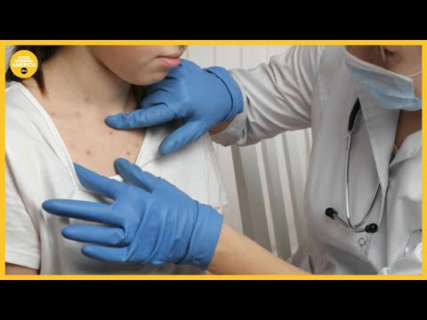 Measles cases in the US approach 30-year high