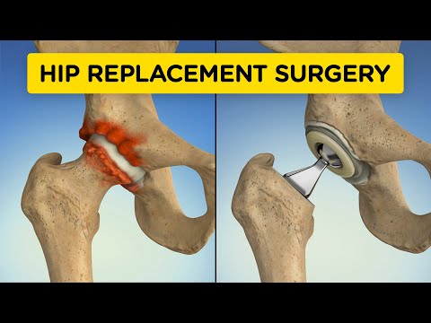 Hip Replacement Surgery 3D Medical Animation | Hip Joint Replacement Explained (Hip Arthroplasty)