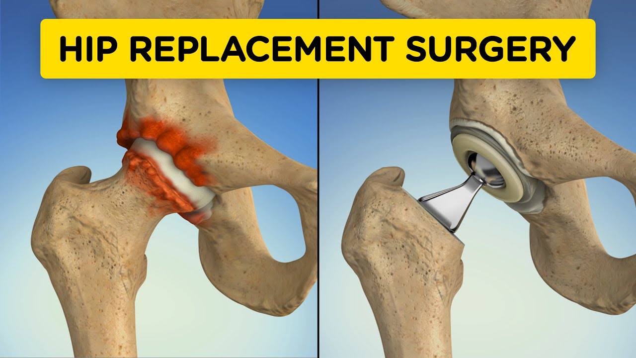 Hip Replacement Surgery 3D Medical Animation | Hip Joint Replacement Explained (Hip Arthroplasty)