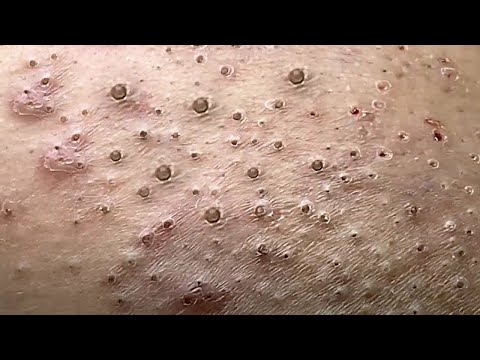 Make your Acne Treatment Huong Da Nang#494 | acne 2022
