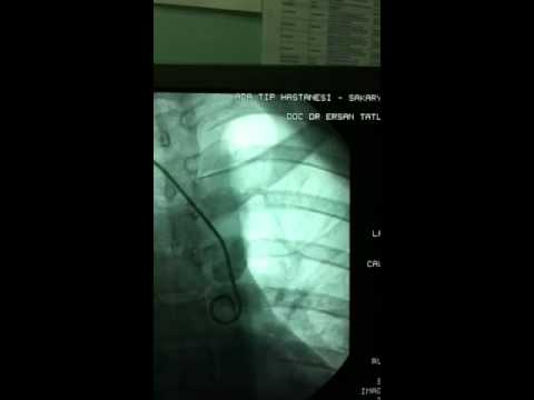 Coarctation of the aorta